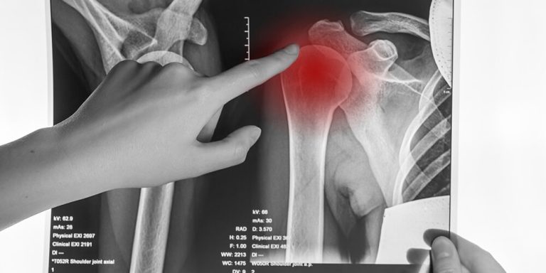 How Does Shoulder Removal Happen